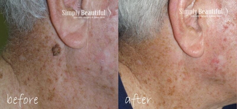 Laser Age Warts Removal - Dr Peter Kim Surgery - Skin Cancer, Cosmetic ...