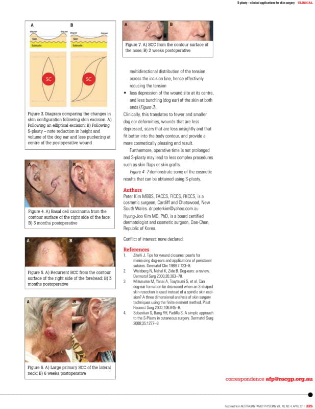 FAQ Skin Cancer Surgery - Eastwood Skin Cancer Clinic