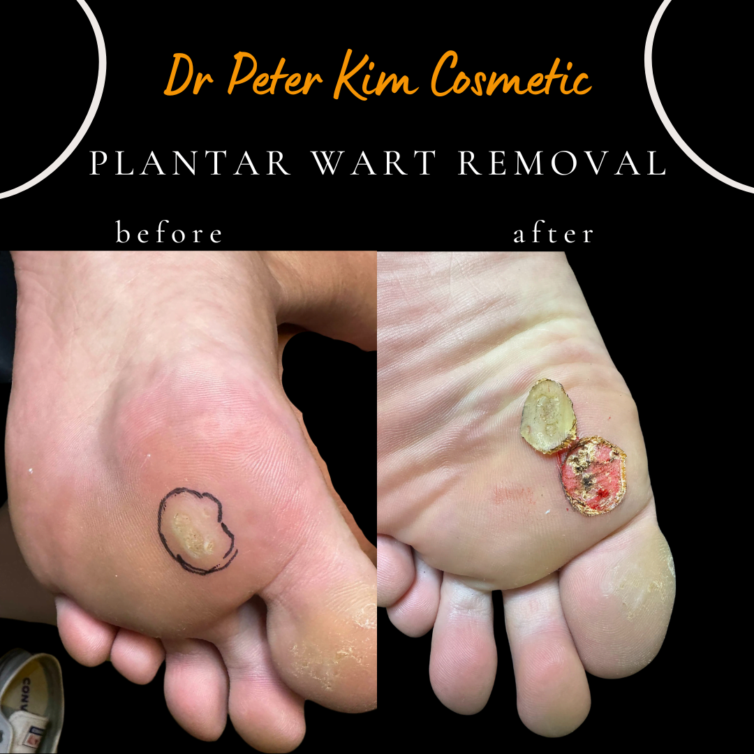 Planters Wart Removal Plant Warts Treatment TBPNUG