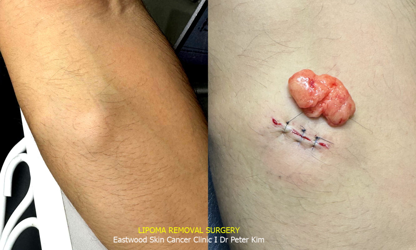 MINOR SKIN SURGERY CLINIC SYDNEY - Dr Peter Kim Surgery - Skin Cancer ...