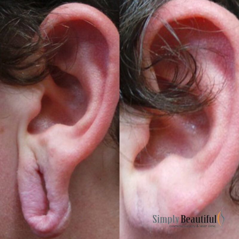 split earlobe repair surgery