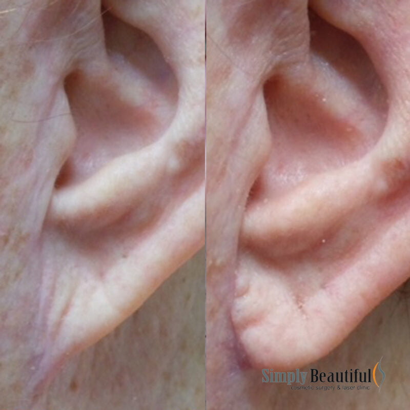 Gauged, Torn & Stretched Earlobe Repair Sydney