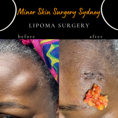 Lipoma surgery, Treatment, Removal Sydney - Dr Peter Kim Surgery - Skin ...