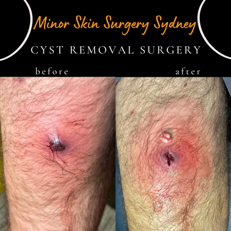 Cyst Surgery, Cyst Removal, Cyst Treatment Sydney