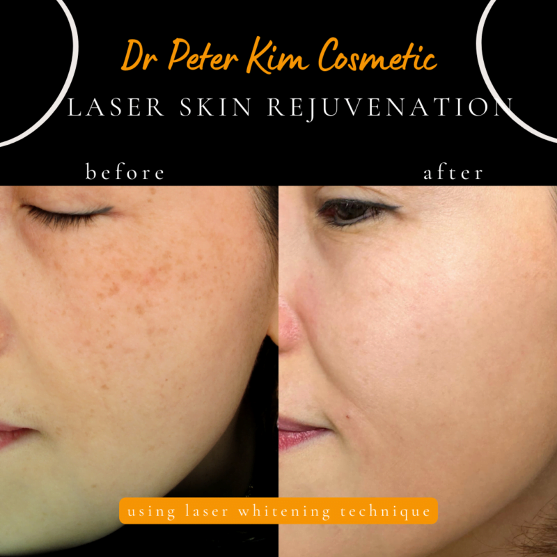 Laser Skin Whitening (Rejuvenation) - Dr Peter Kim Surgery - Skin ...