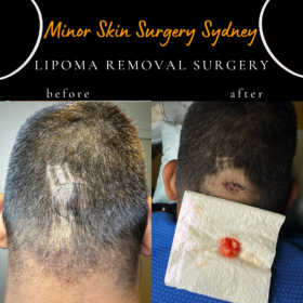 Lipoma surgery, Treatment, Removal Sydney - Dr Peter Kim Surgery - Skin ...