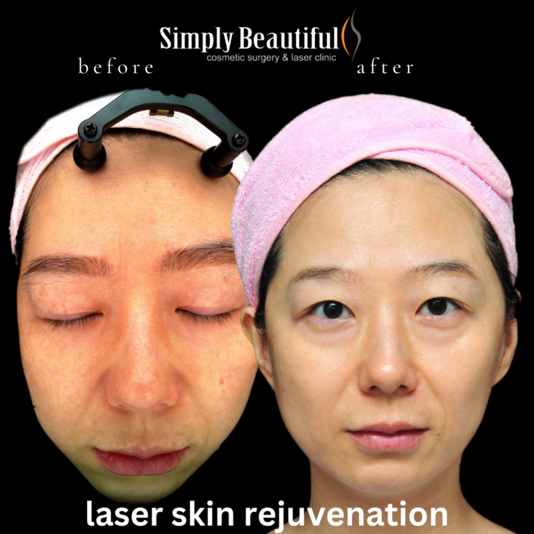 Laser Skin Whitening (Rejuvenation) - Dr Peter Kim Surgery - Skin ...