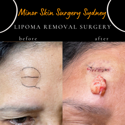 Lipoma surgery, Treatment, Removal Sydney - Dr Peter Kim Surgery - Skin ...