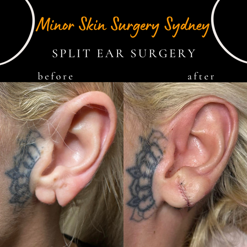Gauged, Torn & Stretched Earlobe Repair Sydney
