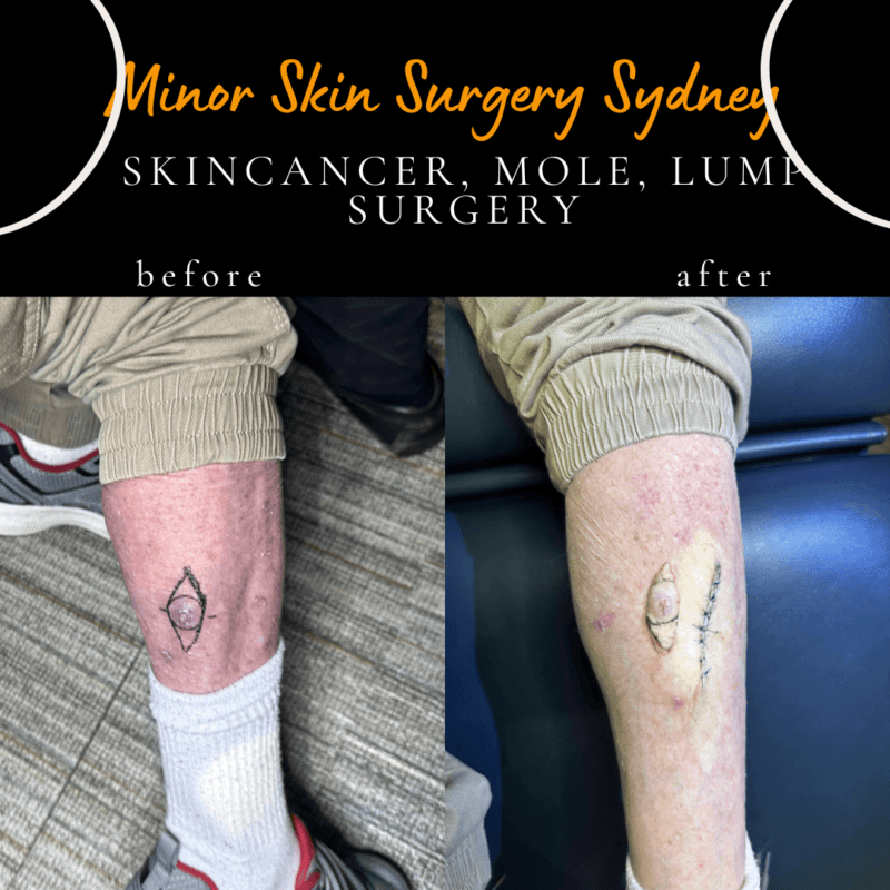 FAQ Skin Cancer Surgery - Eastwood Skin Cancer Clinic
