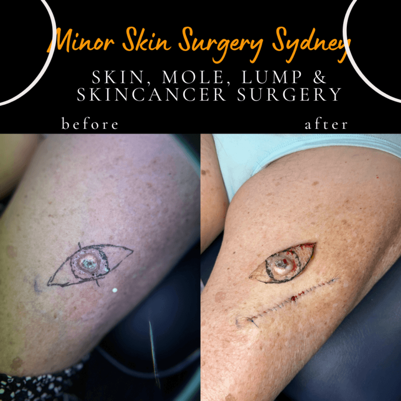 FAQ Skin Cancer Surgery - Eastwood Skin Cancer Clinic