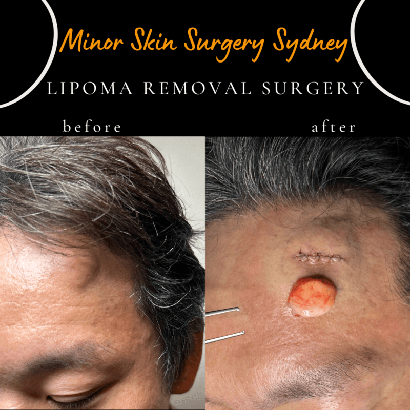 Lipoma surgery, Treatment, Removal Sydney - Dr Peter Kim Surgery - Skin ...