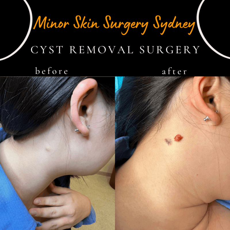 Cyst Surgery, Cyst Removal, Cyst Treatment Sydney