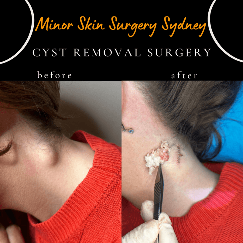Cyst Surgery, Cyst Removal, Cyst Treatment Sydney