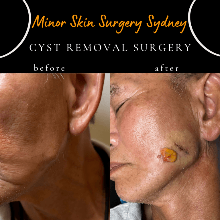 Cyst Surgery, Cyst Removal, Cyst Treatment Sydney