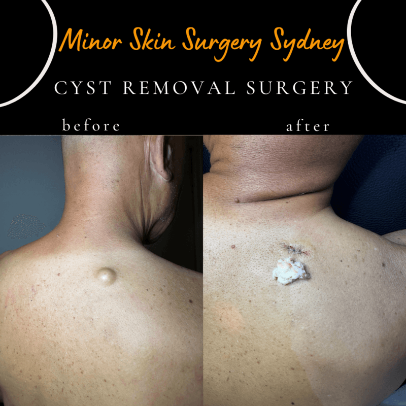 Cyst Surgery, Cyst Removal, Cyst Treatment Sydney