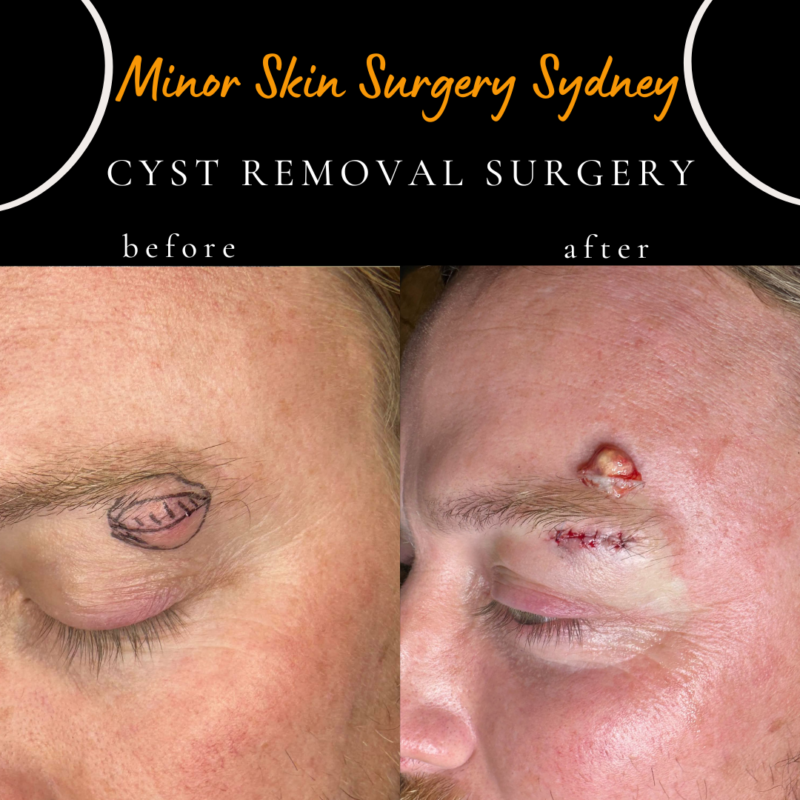 Cyst Surgery, Cyst Removal, Cyst Treatment Sydney