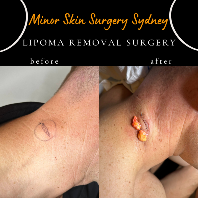 Lipoma surgery, Treatment, Removal Sydney - Dr Peter Kim Surgery - Skin ...