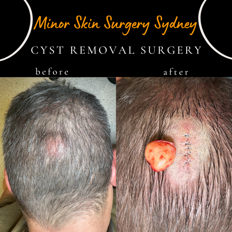 Cyst Surgery, Cyst Removal, Cyst Treatment Sydney