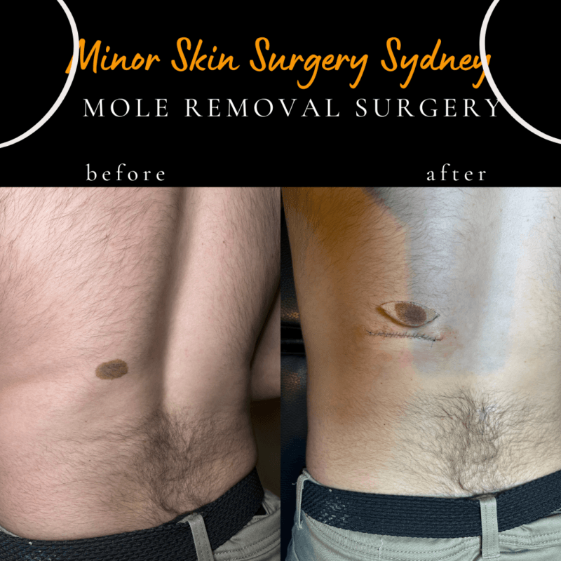 Mole Removal Surgery Sydney - Dr Peter Kim Surgery - Skin Cancer ...