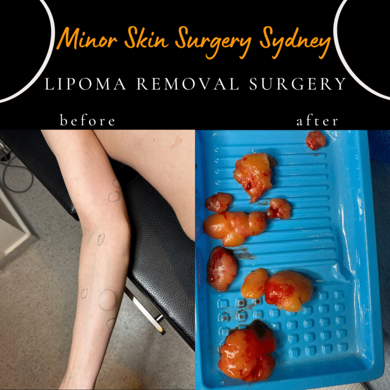 Lipoma surgery, Treatment, Removal Sydney - Dr Lipoma Popper Sydney ...