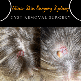 Cyst Surgery, Cyst Removal, Cyst Treatment Sydney