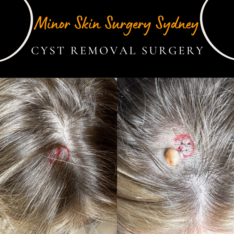 Cyst Surgery, Cyst Removal, Cyst Treatment Sydney