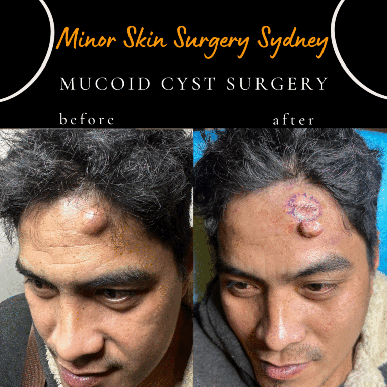 Cyst Surgery, Cyst Removal, Cyst Treatment Sydney