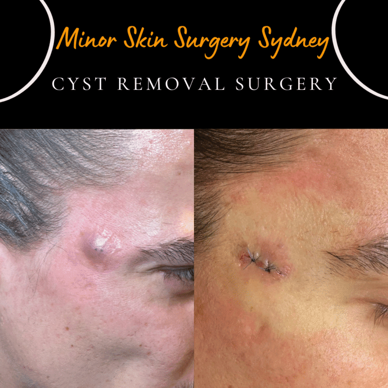 Cyst Surgery, Cyst Removal, Cyst Treatment Sydney