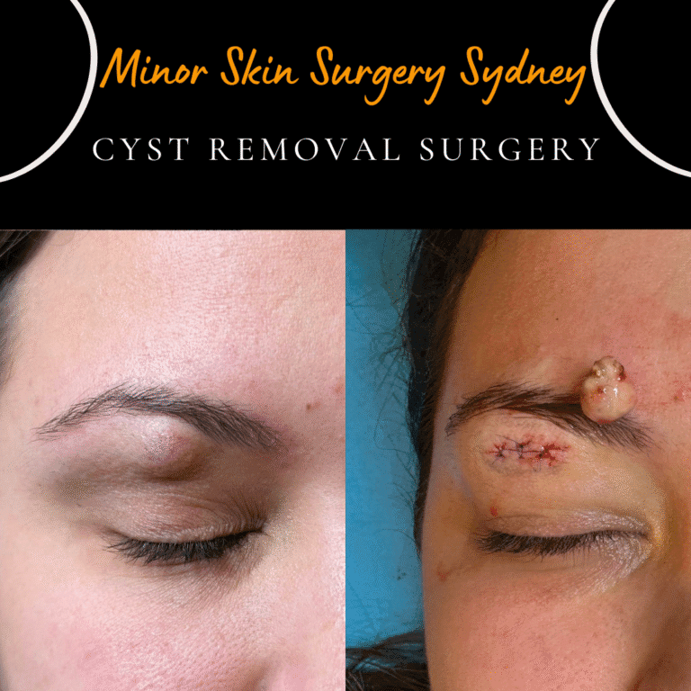 Cyst Surgery, Cyst Removal, Cyst Treatment Sydney