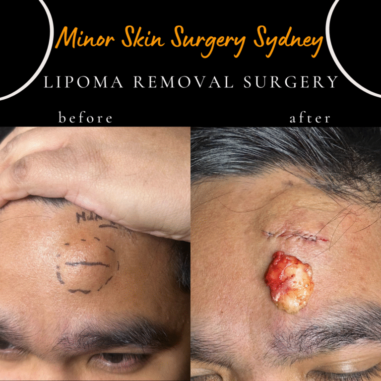 Lipoma surgery, Treatment, Removal Sydney - Dr Peter Kim Surgery - Skin ...