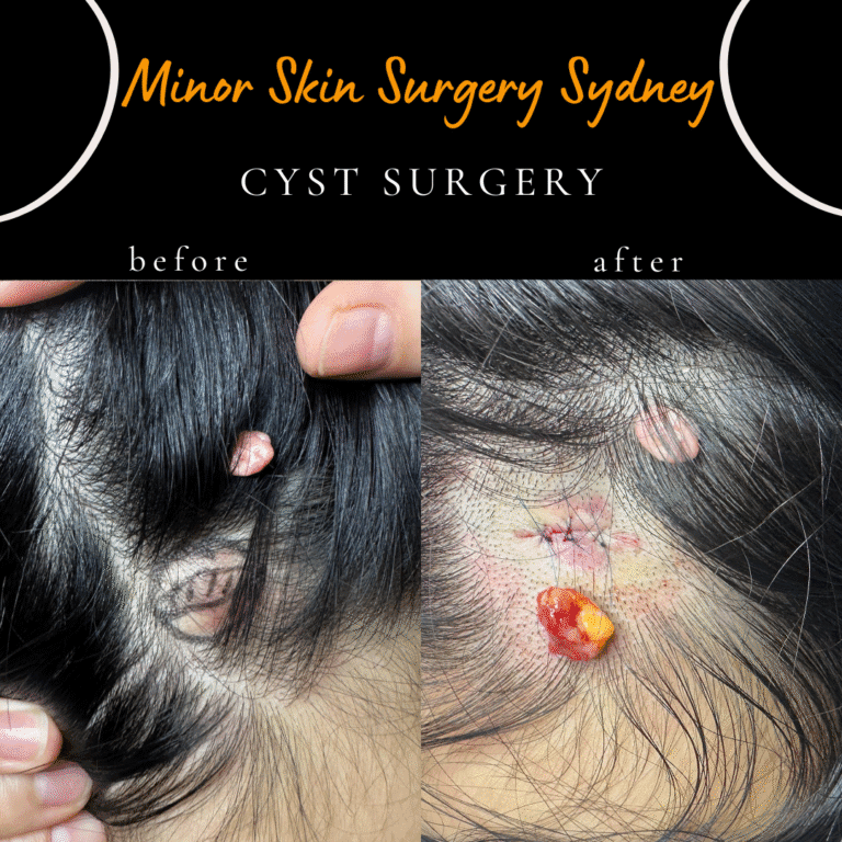 Cyst Surgery, Cyst Removal, Cyst Treatment Sydney