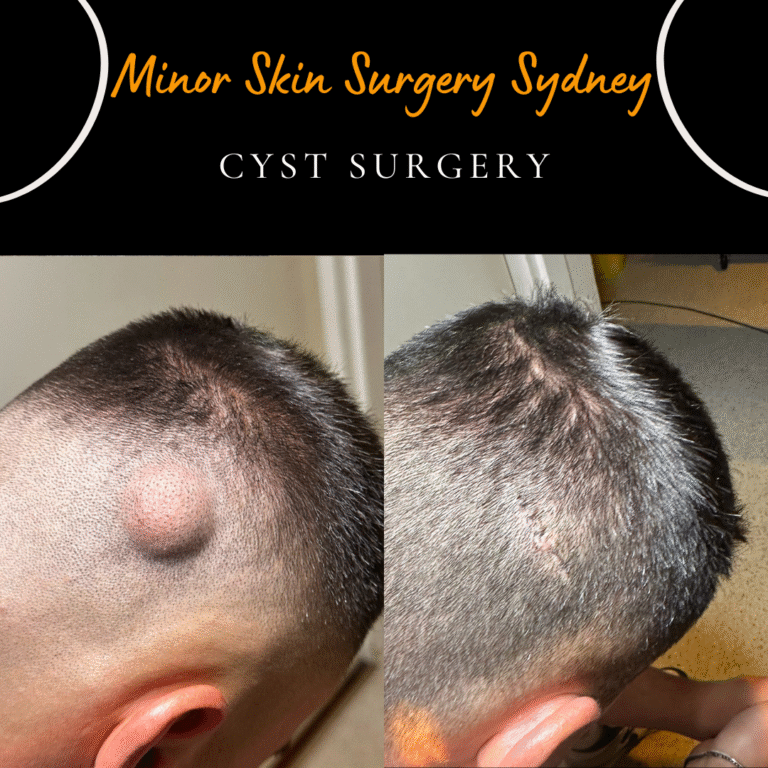 Cyst Surgery, Cyst Removal, Cyst Treatment Sydney