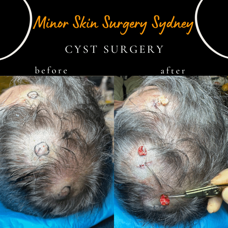Cyst Surgery, Cyst Removal, Cyst Treatment Sydney