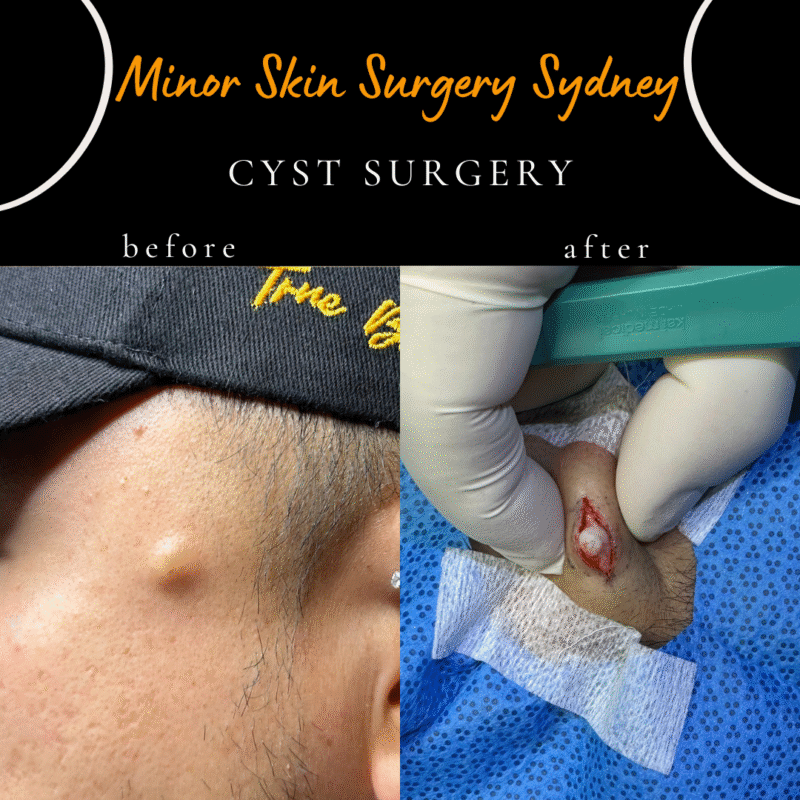 Cyst Surgery, Cyst Removal, Cyst Treatment Sydney
