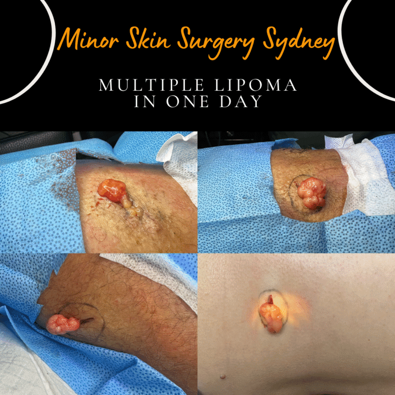 Lipoma surgery, Treatment, Removal Sydney - Dr Peter Kim Surgery - Skin ...