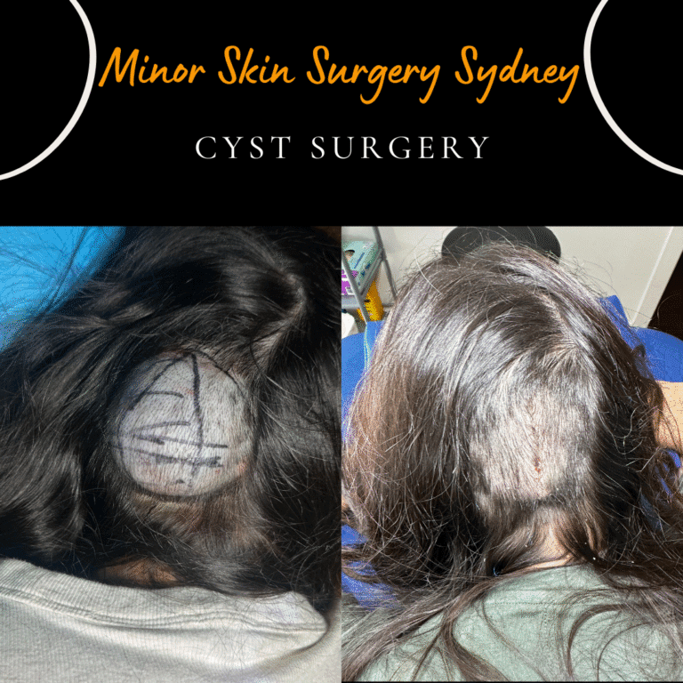 Cyst Surgery, Cyst Removal, Cyst Treatment Sydney