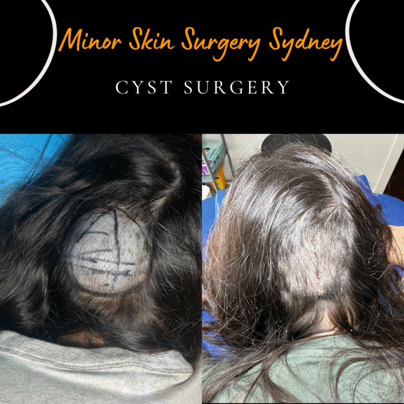 Cyst Surgery, Cyst Removal, Cyst Treatment Sydney