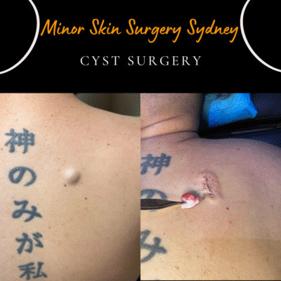 Cyst Surgery, Cyst Removal, Cyst Treatment Sydney