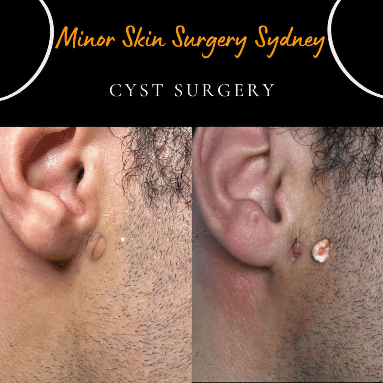 Cyst Surgery, Cyst Removal, Cyst Treatment Sydney