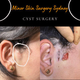 Cyst Surgery, Cyst Removal, Cyst Treatment Sydney