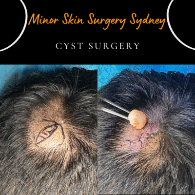 Cyst Surgery, Cyst Removal, Cyst Treatment Sydney