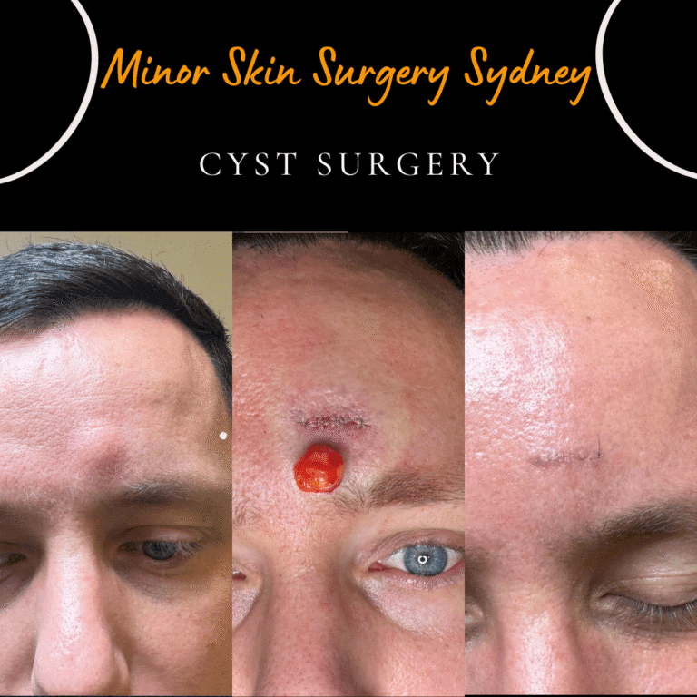 Cyst Surgery, Cyst Removal, Cyst Treatment Sydney