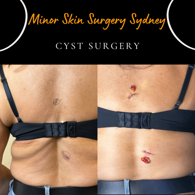 Cyst Surgery, Cyst Removal, Cyst Treatment Sydney