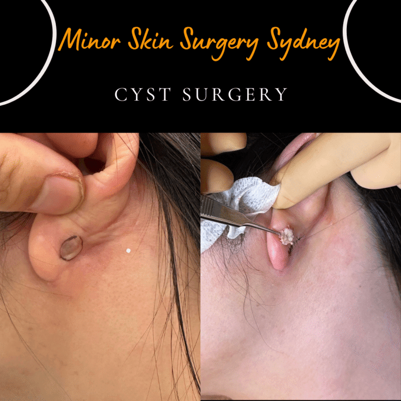 Cyst Surgery, Cyst Removal, Cyst Treatment Sydney