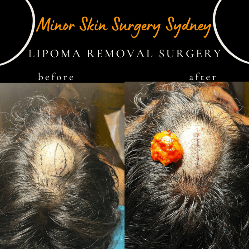 Lipoma surgery, Treatment, Removal Sydney - Dr Peter Kim Surgery - Skin ...