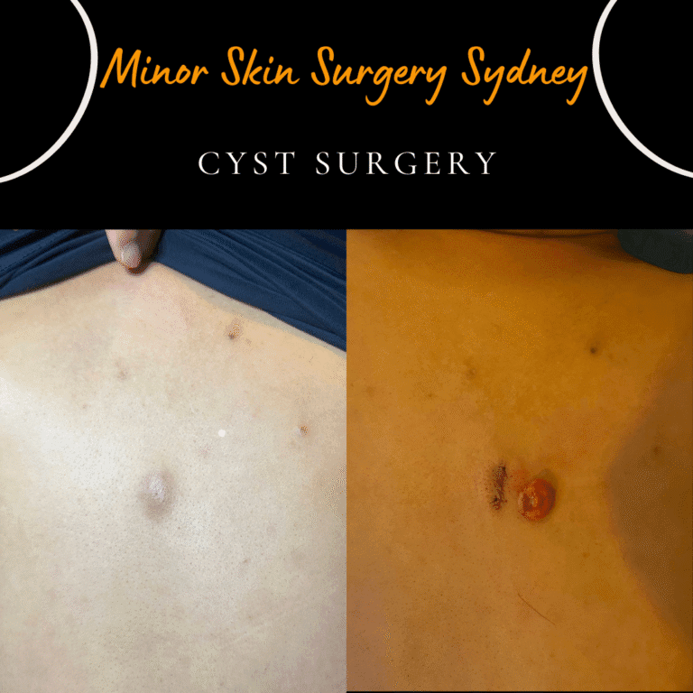 Cyst Surgery, Cyst Removal, Cyst Treatment Sydney