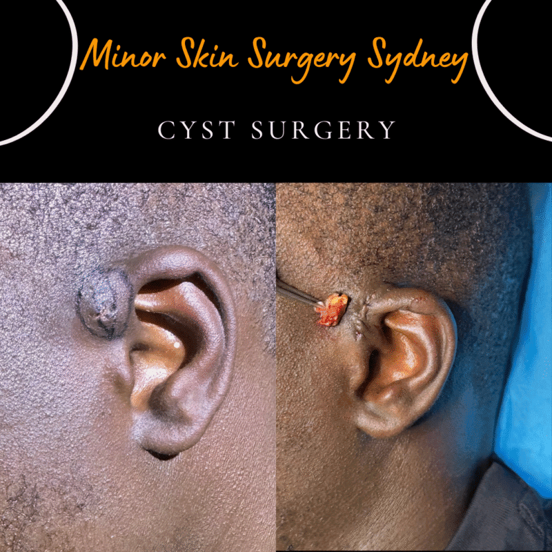 Cyst Surgery, Cyst Removal, Cyst Treatment Sydney