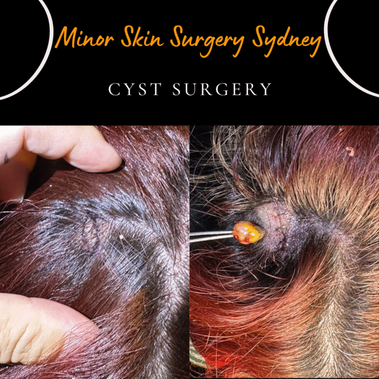 Cyst Surgery, Cyst Removal, Cyst Treatment Sydney