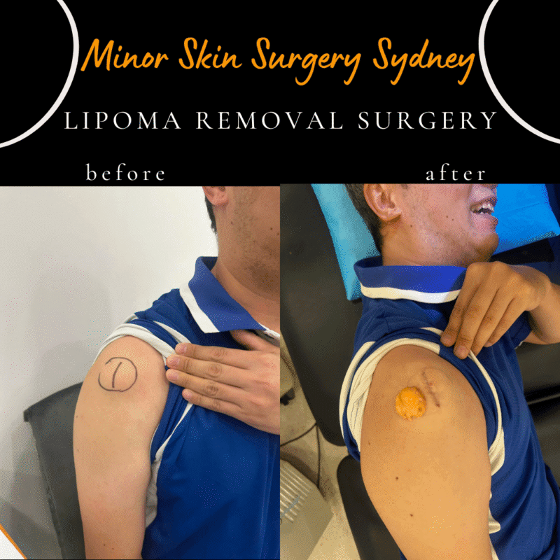 Lipoma surgery, Treatment, Removal Sydney - Dr Peter Kim Surgery - Skin ...